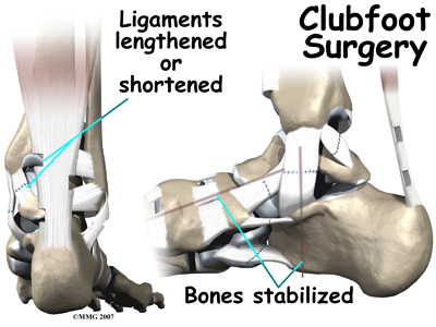 Clubfoot | Central Orthopedic Group